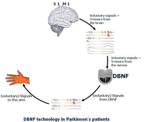 DNF-System - LSB MedTech